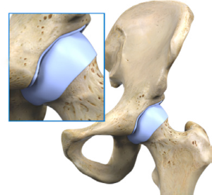 Preguntas clave sobre la lesión de labrum acetabular