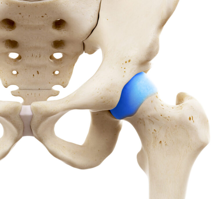 Preguntas clave sobre la lesión de labrum acetabular